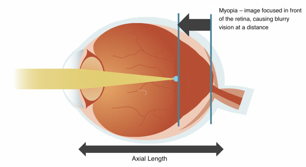 Myopia (nearsightedness): A Pervasive Disease | Tennessee Vision Therapy